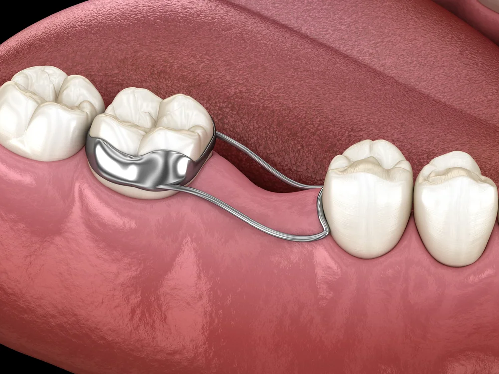 Does My Child Really Need A Space Maintainer?