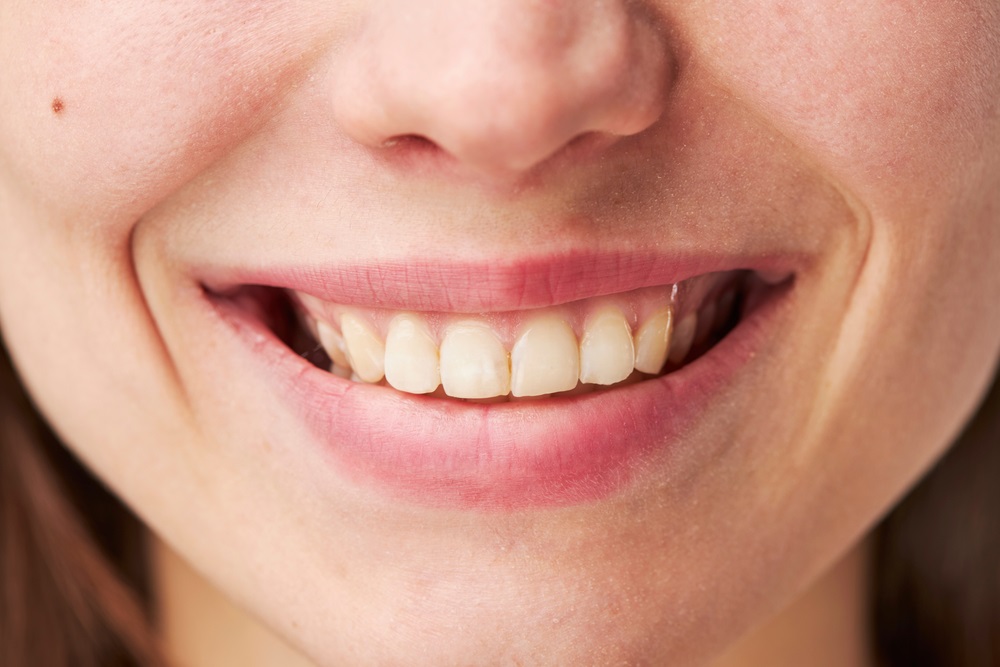 How Do You Get Rid of Brown Stains Between Teeth?